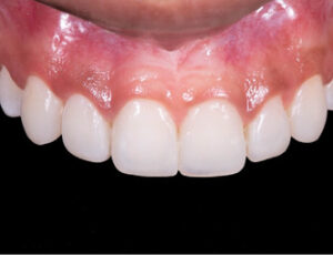 Direct Anterior Resin Composite Restorations: An Update on Esthetic ...