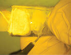 Direct Anterior Resin Composite Restorations: An Update on Esthetic ...