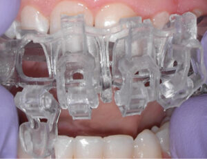 Direct Anterior Resin Composite Restorations: An Update on Esthetic ...