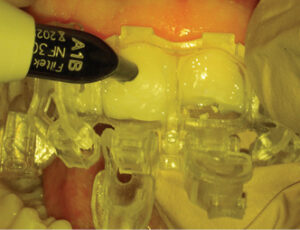 Direct Anterior Resin Composite Restorations: An Update on Esthetic ...