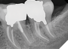 The Lateral Puff in Endodontics: Clinically Significant or a ...