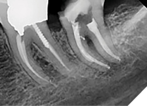 The Lateral Puff in Endodontics: Clinically Significant or a ...