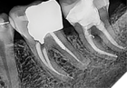 The Lateral Puff in Endodontics: Clinically Significant or a ...