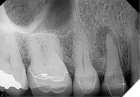 The Lateral Puff in Endodontics: Clinically Significant or a ...