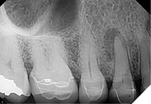 The Lateral Puff in Endodontics: Clinically Significant or a ...