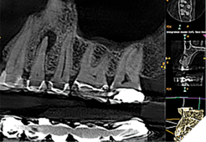 The Lateral Puff in Endodontics: Clinically Significant or a ...