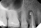 The Lateral Puff in Endodontics: Clinically Significant or a ...