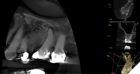 The Lateral Puff in Endodontics: Clinically Significant or a ...