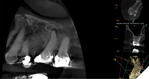 The Lateral Puff in Endodontics: Clinically Significant or a ...