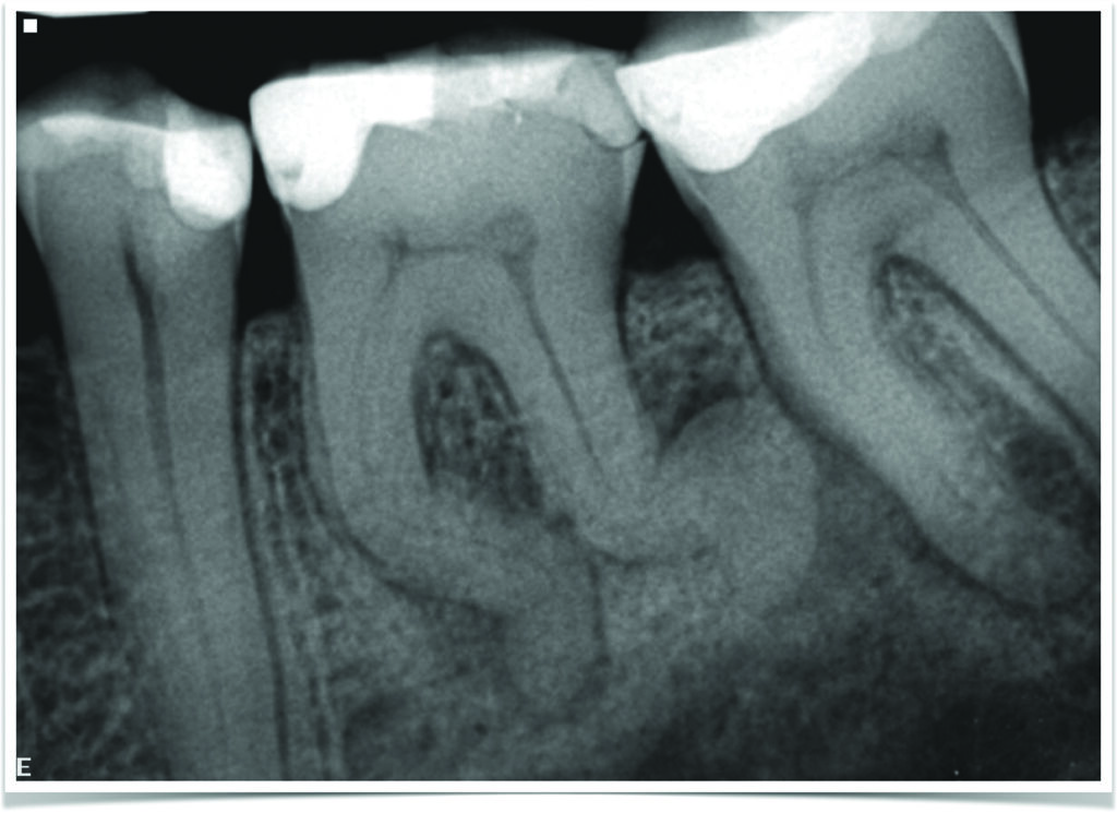 Safe and Effective 3-D Endodontic Disinfection: Laser Assisted ...