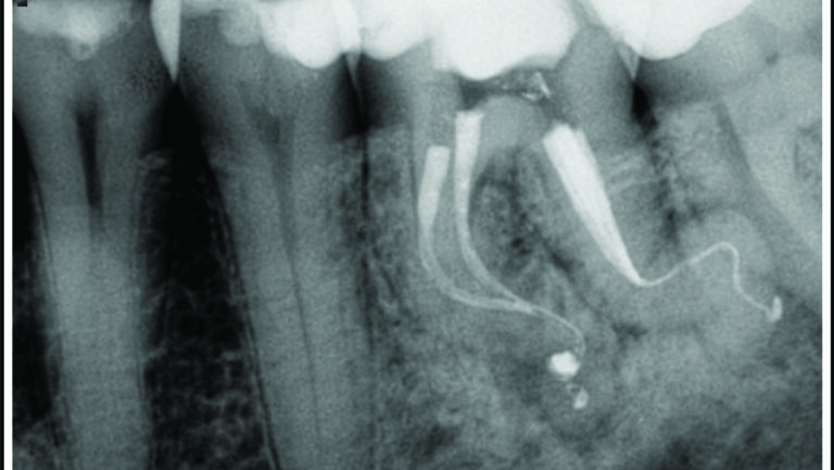 Safe and Effective 3-D Endodontic Disinfection: Laser Assisted Endodontic Irrigation - Oral ...