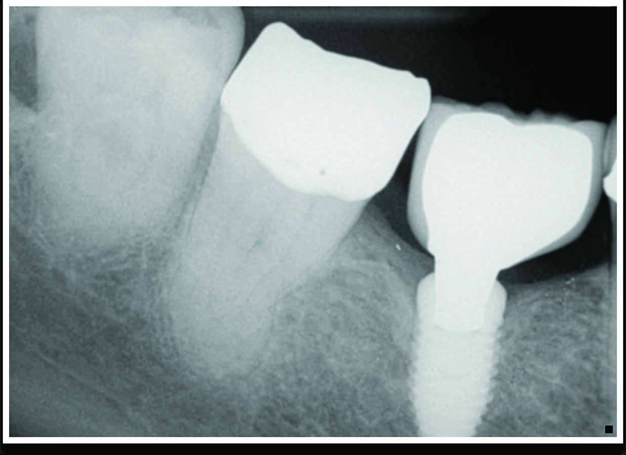 Safe and Effective 3-D Endodontic Disinfection: Laser Assisted ...