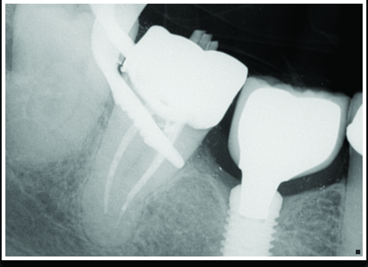 Safe and Effective 3-D Endodontic Disinfection: Laser Assisted ...