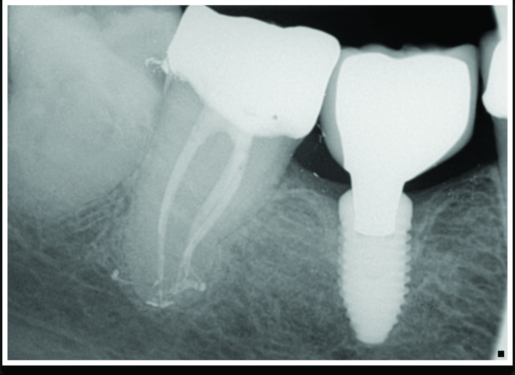 Safe and Effective 3-D Endodontic Disinfection: Laser Assisted ...