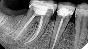 The Lateral Puff in Endodontics: Clinically Significant or a ...