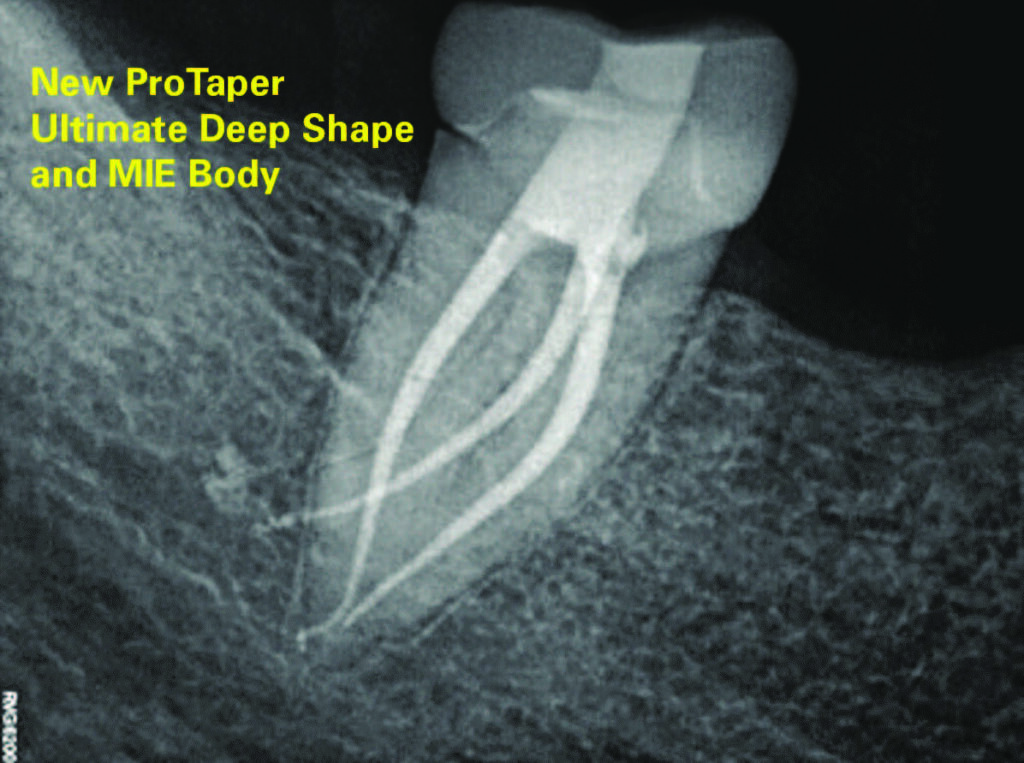 Deep Shape in Endodontics: Significance, Rationale and Benefit - Oral Health Group