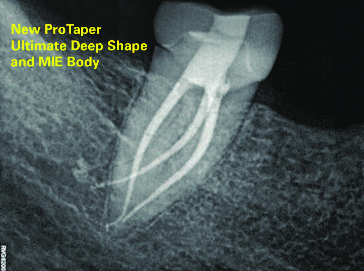 Deep Shape in Endodontics: Significance, Rationale and Benefit - Oral ...