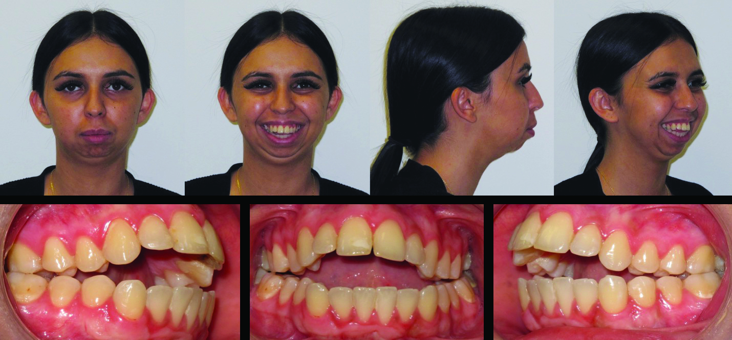 Concomitant Temporomandibular Total Joint Replacement and Orthognathic ...