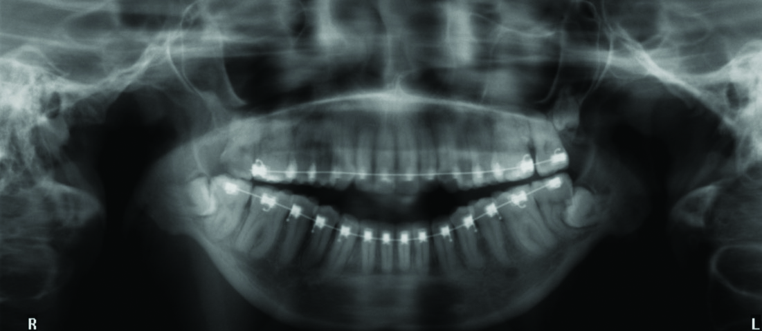 Concomitant Temporomandibular Total Joint Replacement and Orthognathic ...