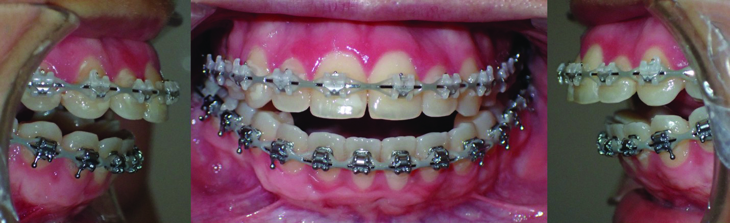 Concomitant Temporomandibular Total Joint Replacement and Orthognathic ...