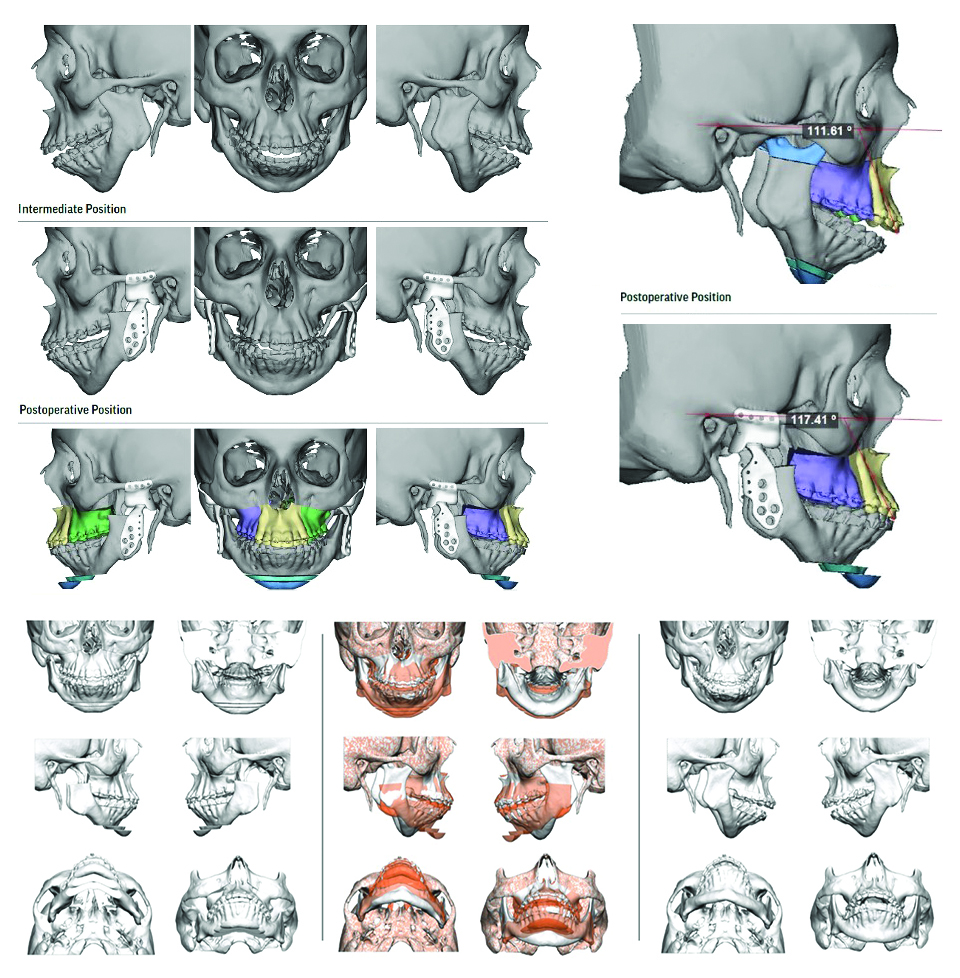 Concomitant Temporomandibular Total Joint Replacement and Orthognathic ...
