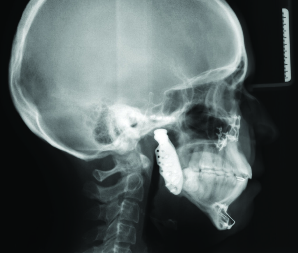 Concomitant Temporomandibular Total Joint Replacement and Orthognathic ...