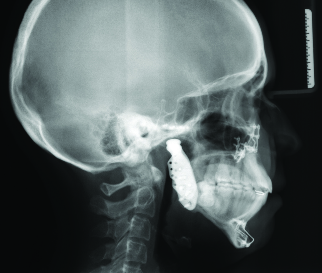 Concomitant Temporomandibular Total Joint Replacement and Orthognathic ...
