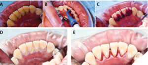 HYBENX® Technology: A Novel Approach to Plaque and Calculus Removal and ...