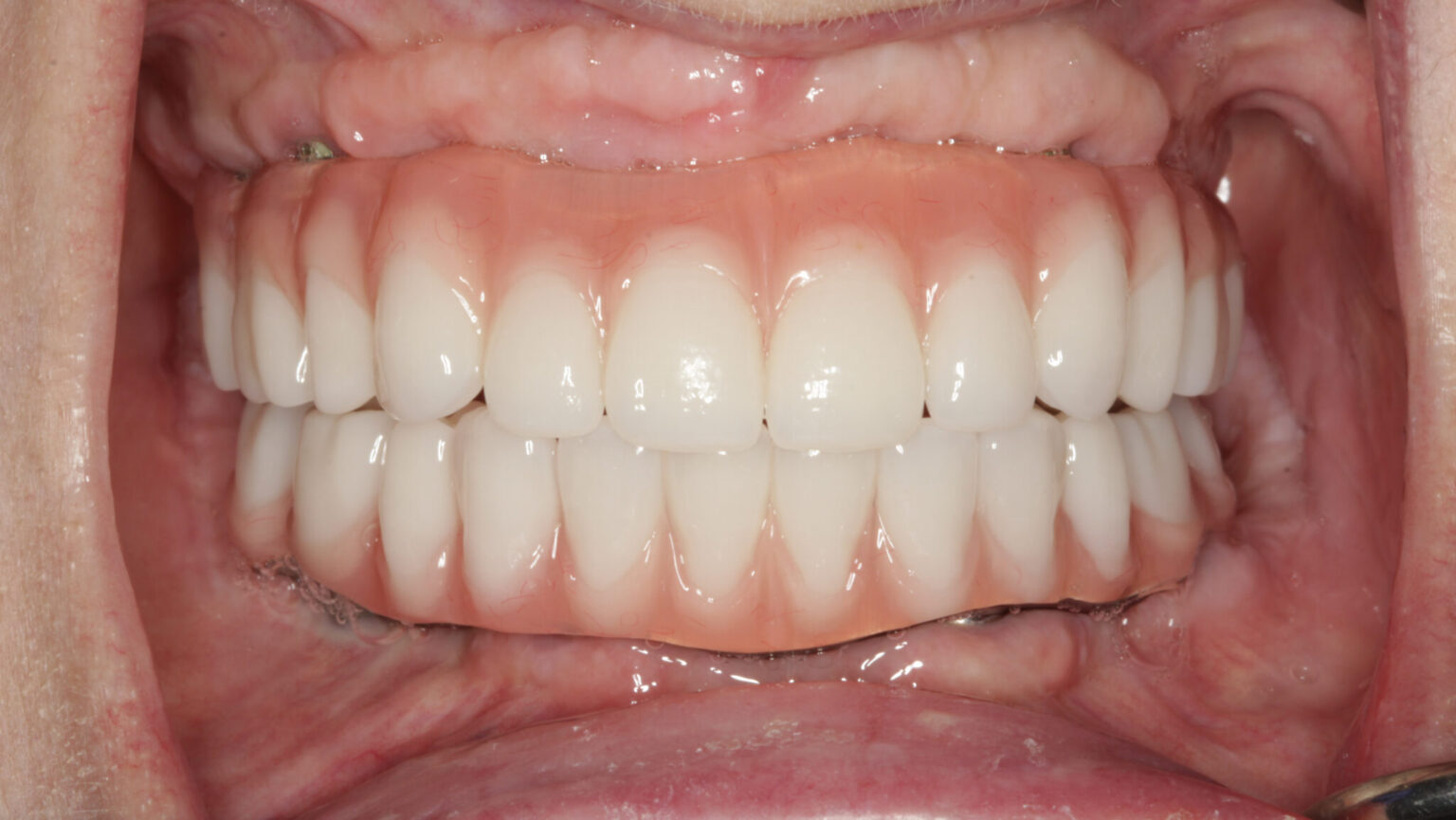 Full Mouth Rehabilitation of Terminal Dentition with Fixed Implant ...