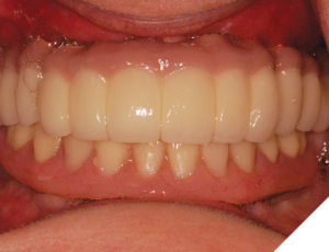 All on X and the Patient Experience - Oral Health Group