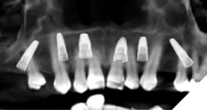 All on X and the Patient Experience - Oral Health Group