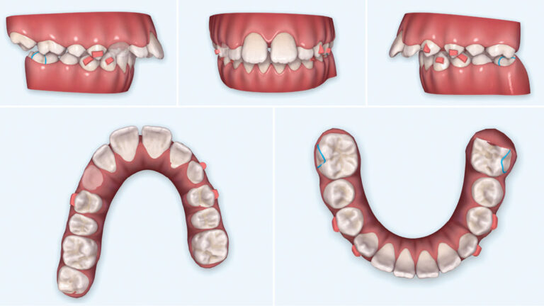 Class II orthodontic treatment of a growing patient using Invisalign ...