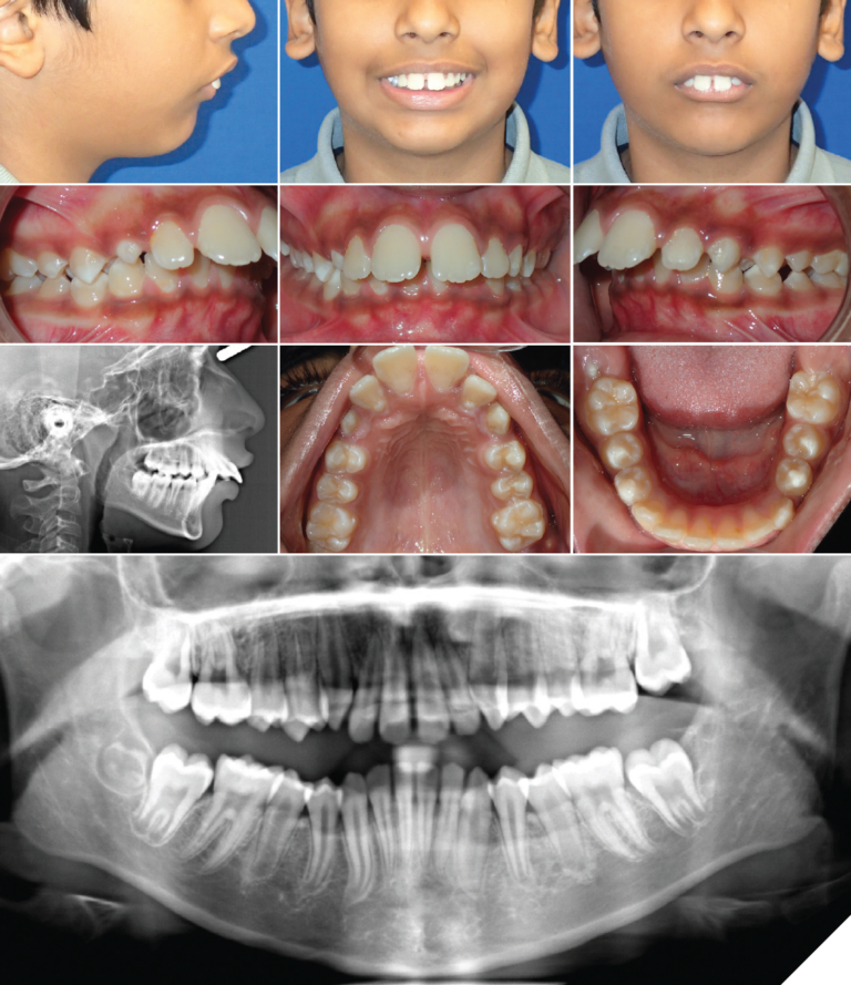 Class II orthodontic treatment of a growing patient using Invisalign ...
