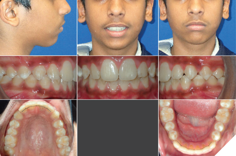 Class II orthodontic treatment of a growing patient using Invisalign ...