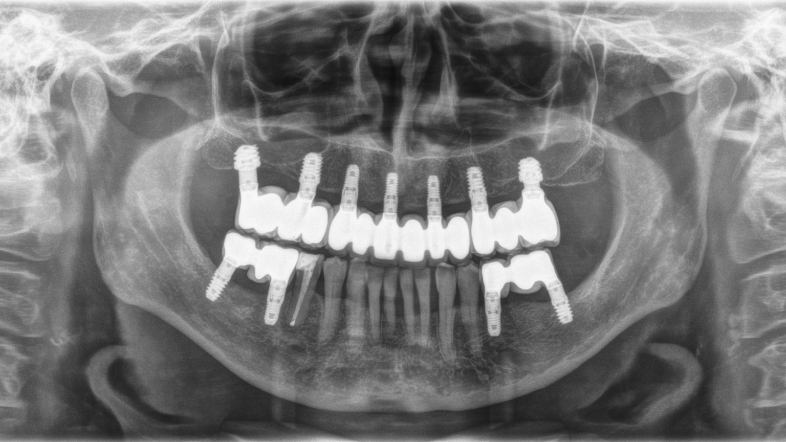 Immediate Loading of Extra-short Implants (6.5 mm in length) - Oral ...