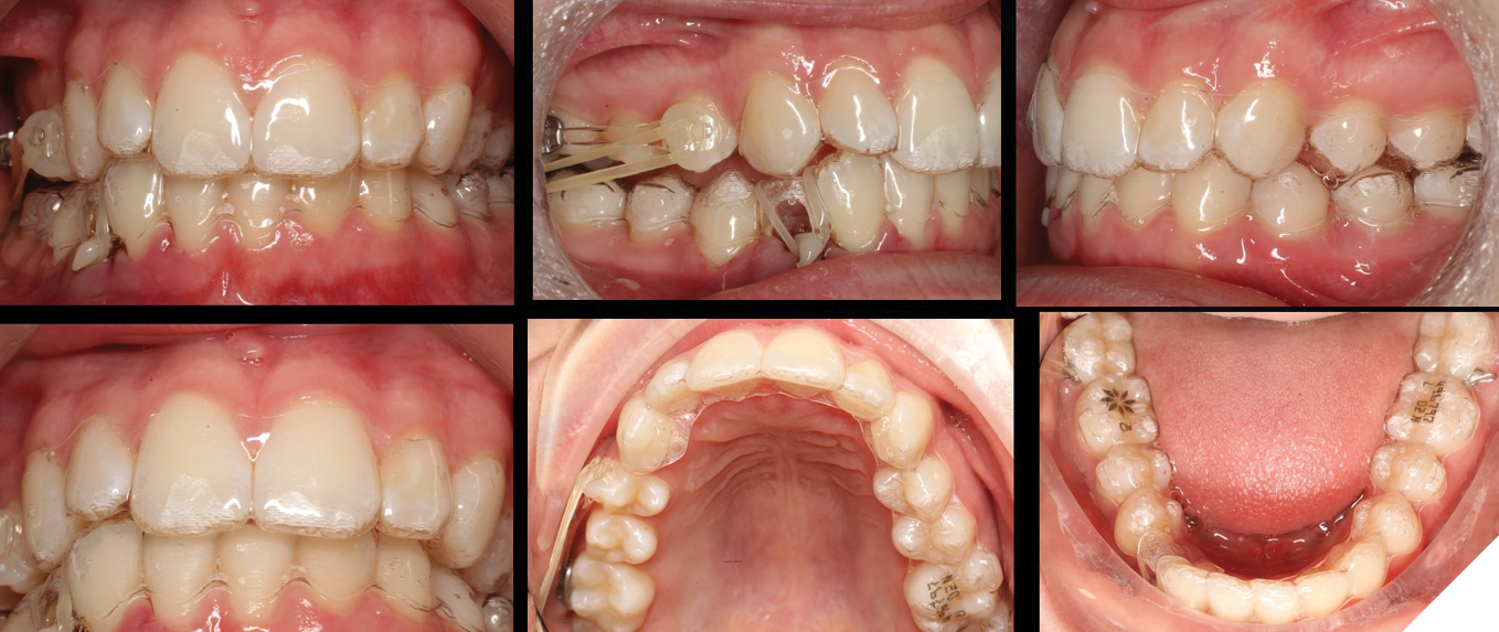 Treatment of a class II subdivision and impacted canine with Clear ...