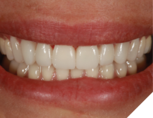 The quest for porcelain veneers – A patient’s journey from concept to ...