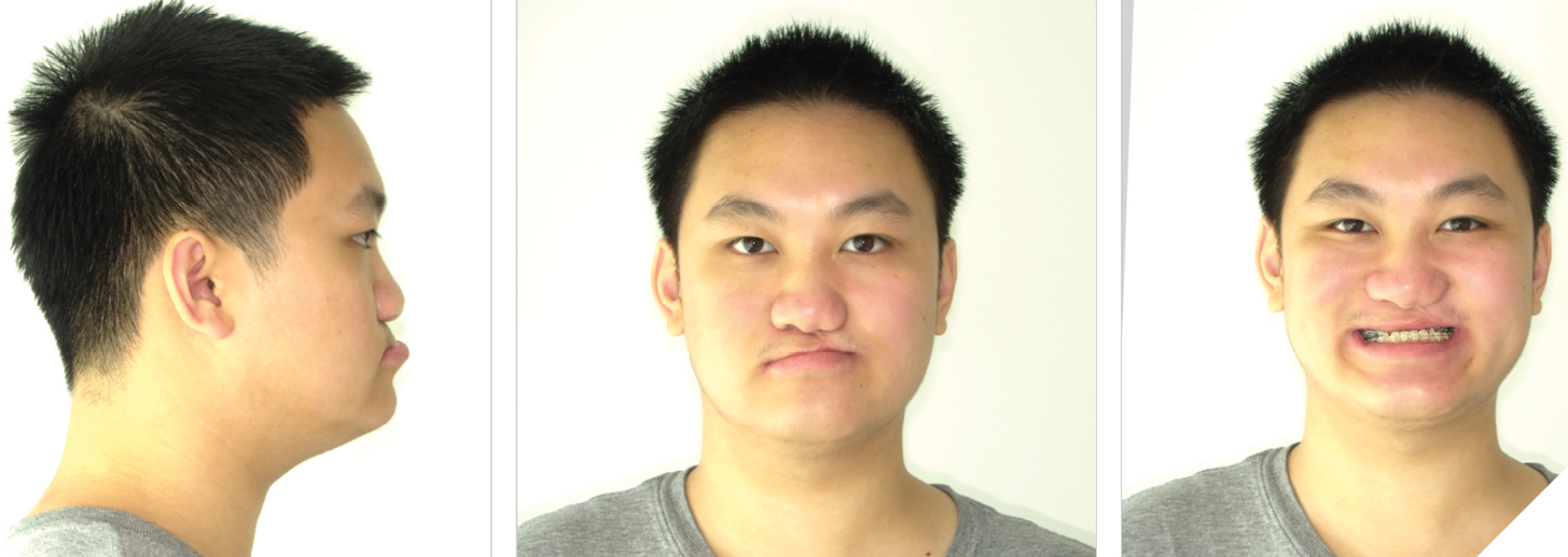 Maxillary distraction using modern techniques - Oral Health Group
