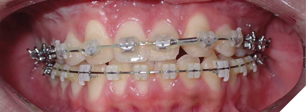 Maxillary distraction using modern techniques - Oral Health Group
