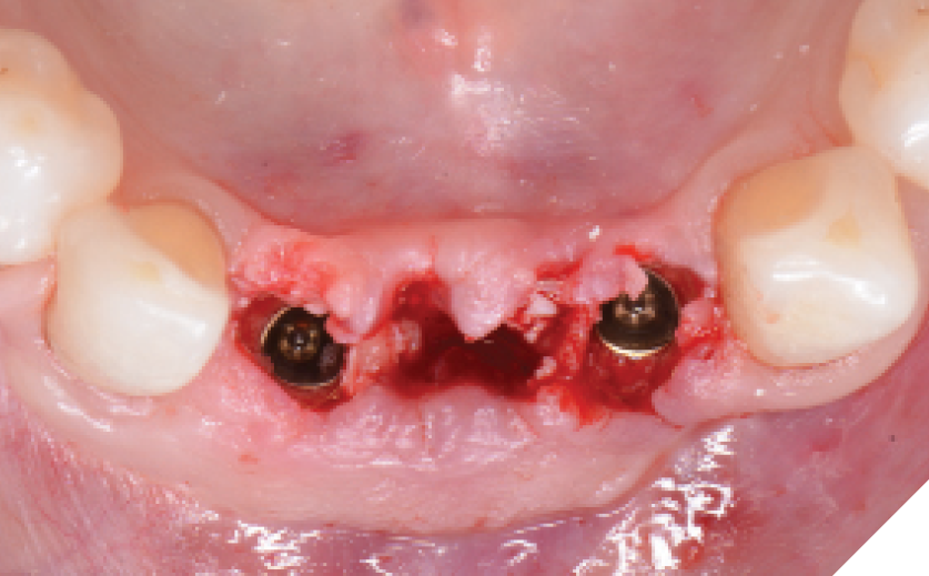 Innovative lower anterior implant therapy utilizing a minimally ...