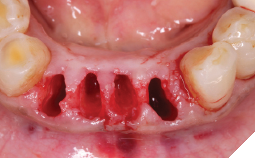 Innovative lower anterior implant therapy utilizing a minimally ...