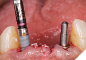 Innovative lower anterior implant therapy utilizing a minimally ...