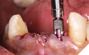 Innovative lower anterior implant therapy utilizing a minimally ...