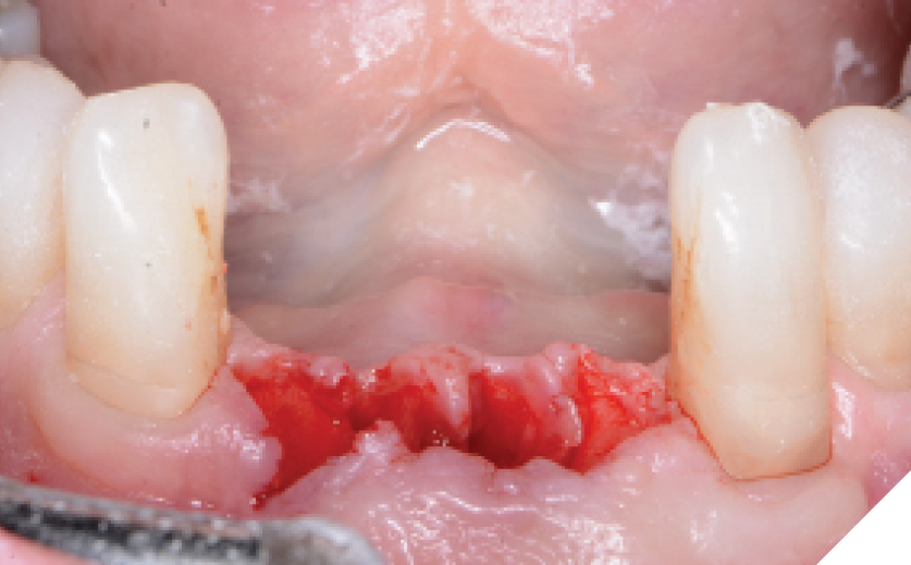 Innovative lower anterior implant therapy utilizing a minimally ...