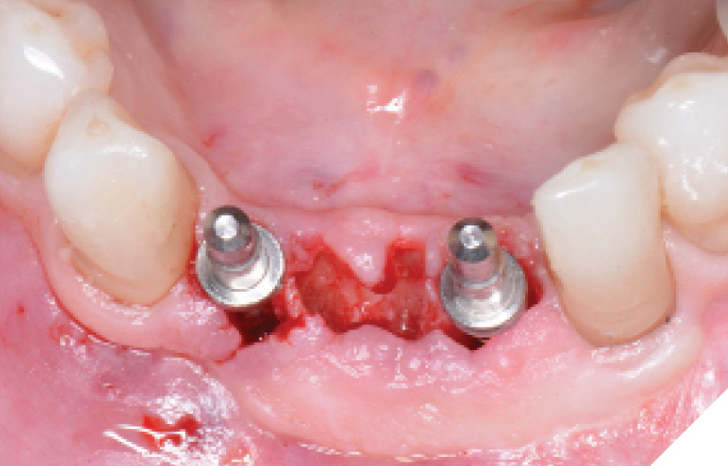 Innovative lower anterior implant therapy utilizing a minimally ...