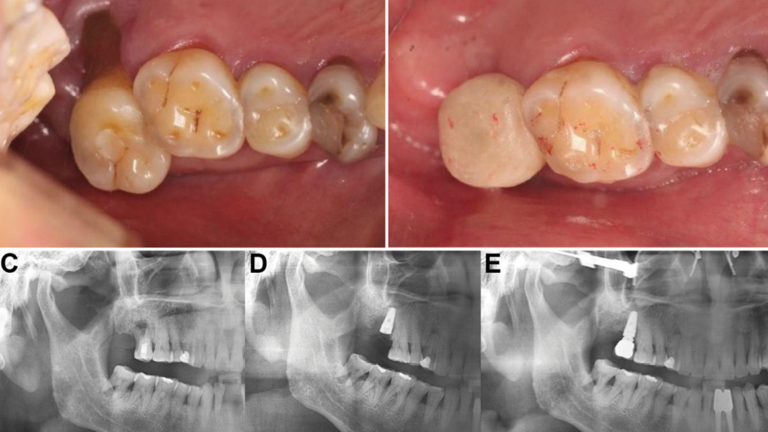 Introducing Leon’s Everted Gingival Pouch (LEGP) technique - Oral ...