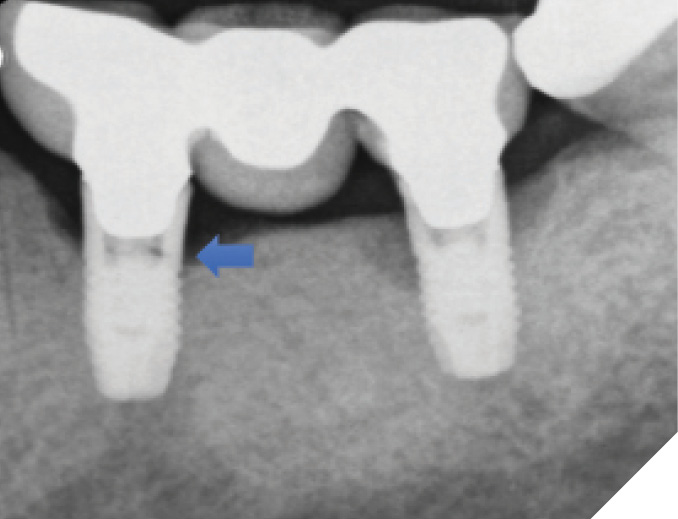 Fracture of dental implants with internal, conical connections: A case ...