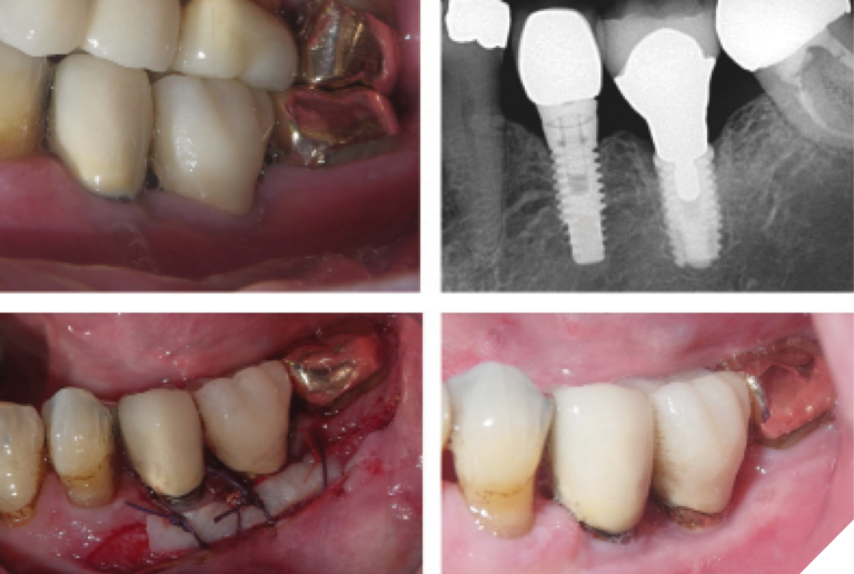 Current management strategies for peri-implant diseases - Oral Health Group