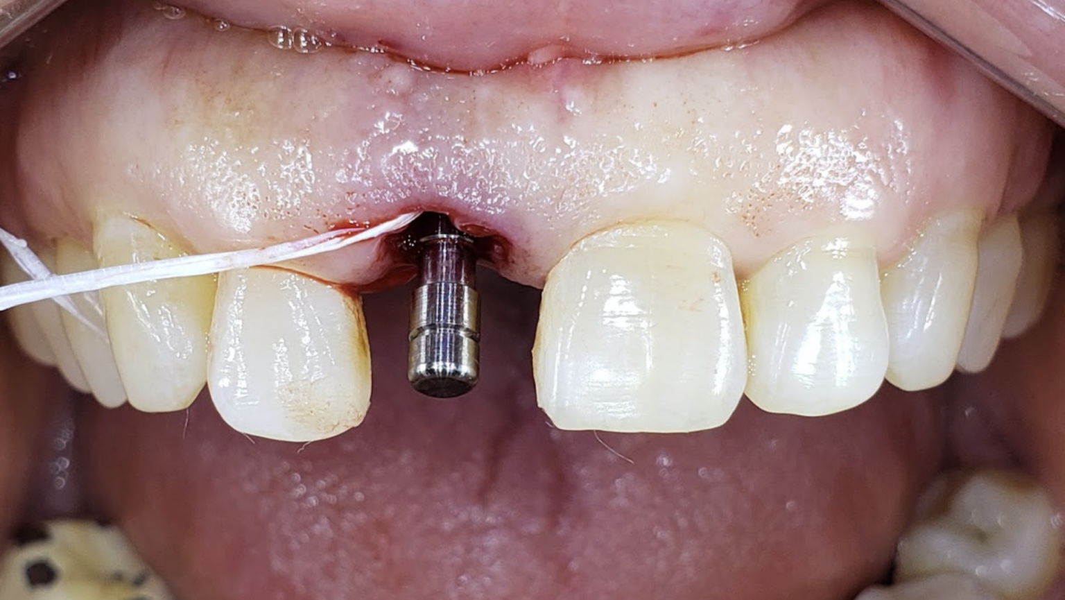 A case report on an immediate anterior implant with immediate provisionalization using the ...