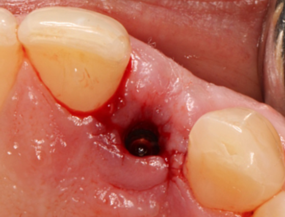 Optimizing outcome with palatally-placed implant in the esthetic zone ...